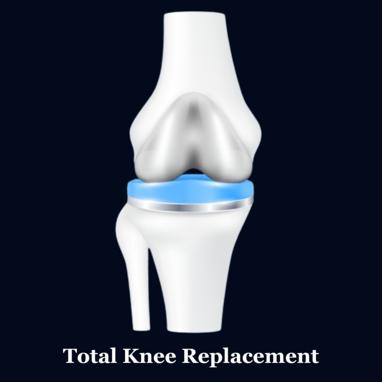 Total Knee Replacement Surgery
